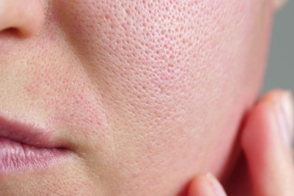 Effectieve Behandeling van Grove Poriën bij Sima Skin