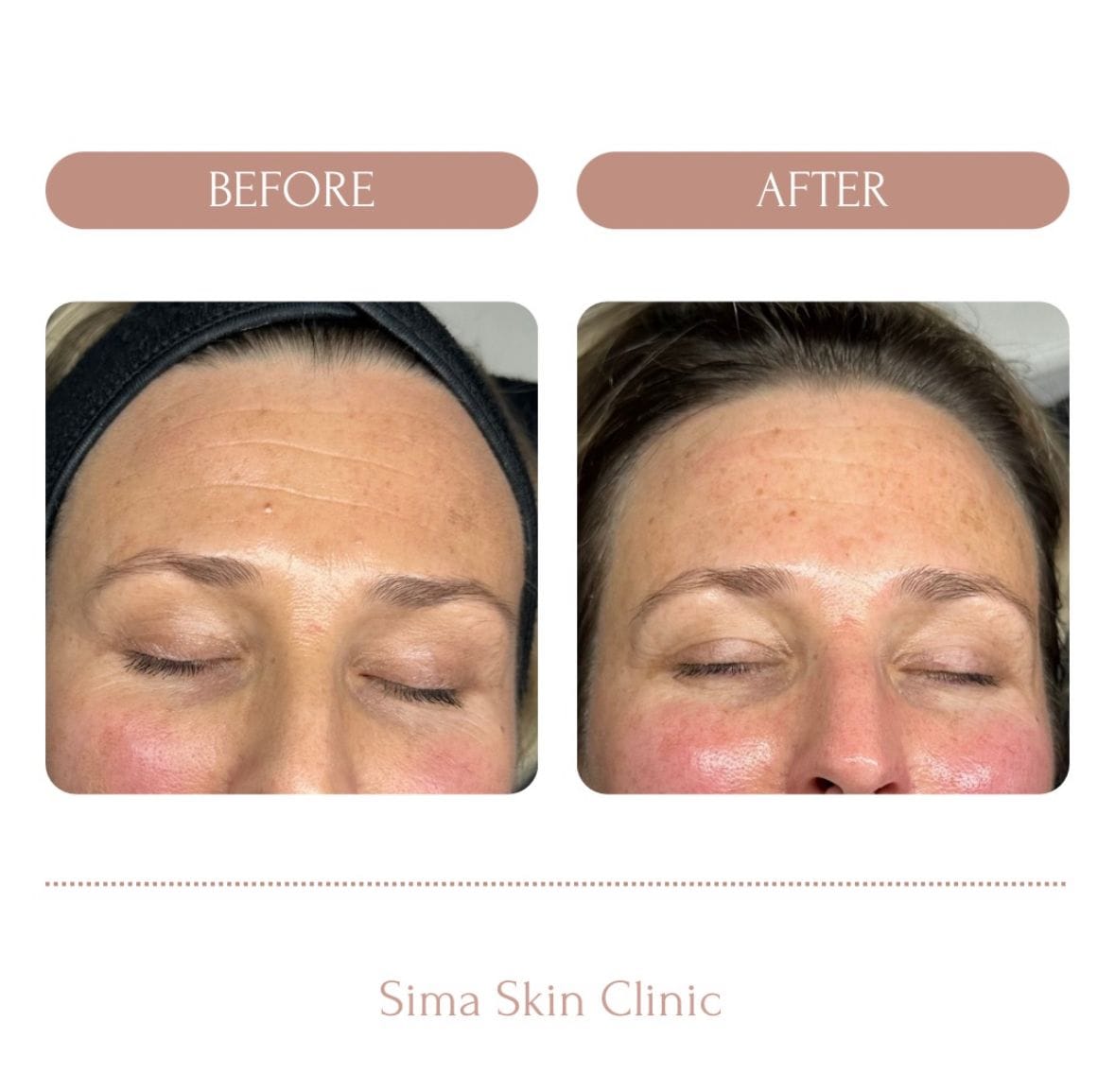 Zichtbare Huidtransformaties | Sima Skin Clinic